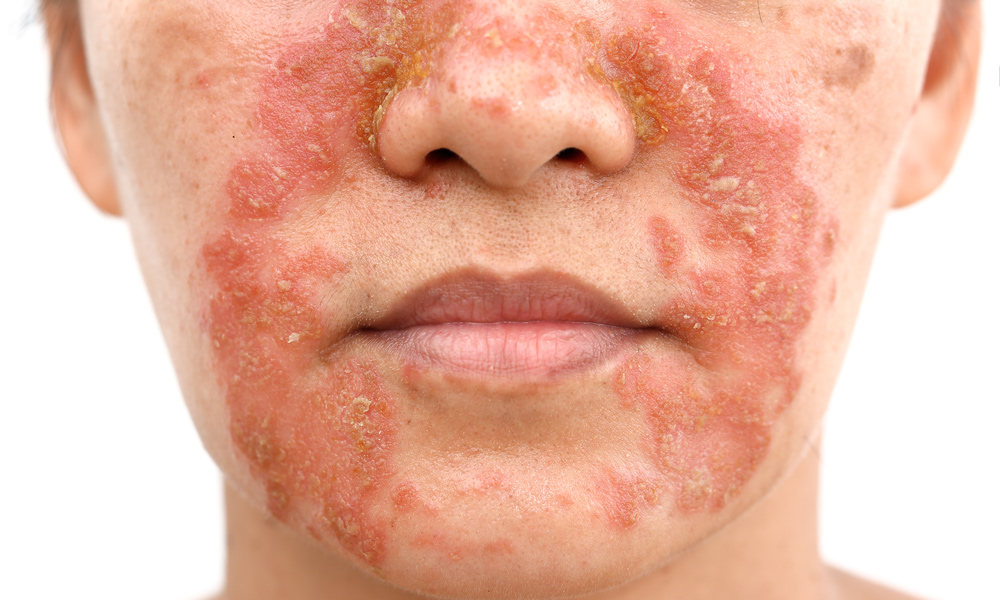 Eczeem in je gezicht: wat doe je eraan? | EG